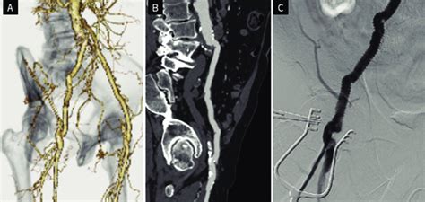A Computed Tomography Angiography Shows A Patent Aorto Bifemoral