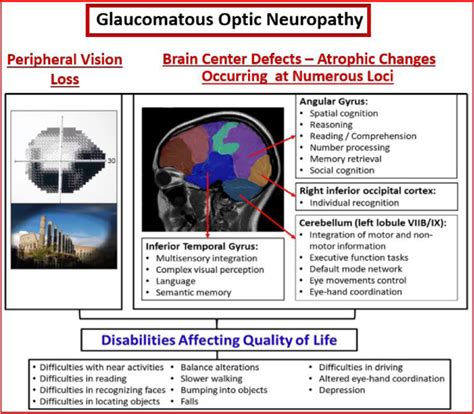 The Deleterious Effects Glaucomatous Optic Neuropathy Gon On Retinal Download Scientific