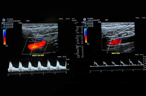 Naif Almutairi On Linkedin Ultrasound Dopplerultrasound
