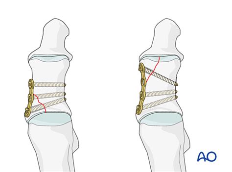 Lag Screw Fixation For Partial Articular Fractures Of The Proximal Hallux