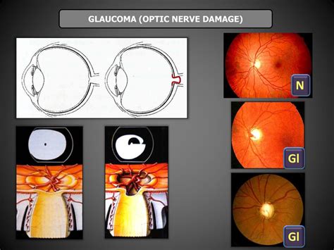 Ppt Keratitis Glaucoma Diagnosis And Treatment Powerpoint