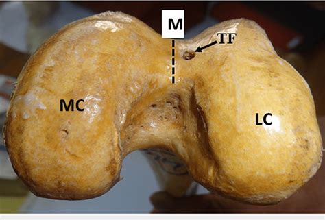 Trochlear Foramen On The Left Of The Midline On The Trochlear Groove Of Download Scientific
