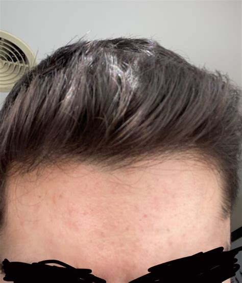 Sudden Purging On Forehead After 7 Months 20mg Is This Normal R