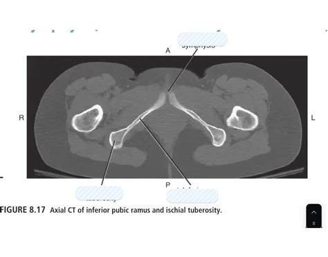Axial Ct Of Inferior Pubic Ramus Quiz