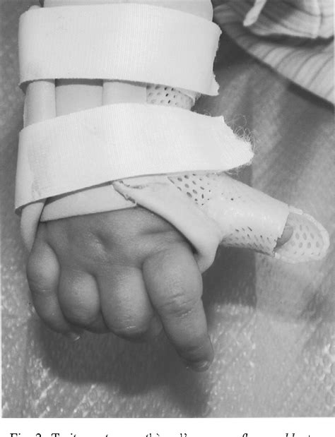 Figure 6 From Flexion Deformities Of The Thumb Clasped Thumb And