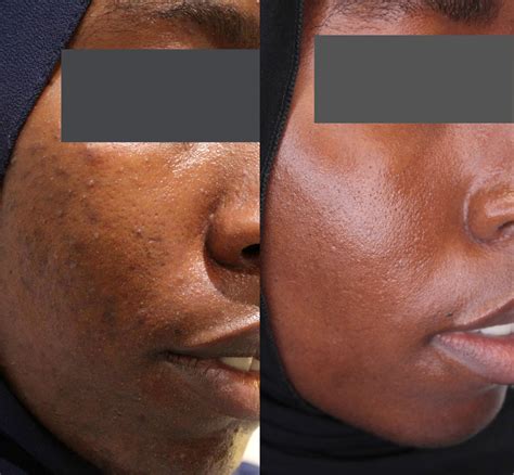 Treatment For Post Inflammatory Hyperpigmentation Cutis Dermatology