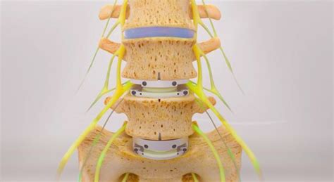Coverage Expansion Continues For Centinel Spines Prodisc L Orthoworld