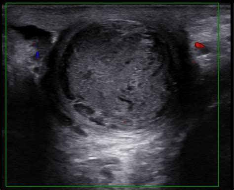 Testicular Epidermoid Cyst