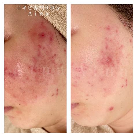 薬で腫れてしまったが、赤みも落ち着いてきました ｜ 横浜ニキビ・ニキビ跡改善専門サロンaina