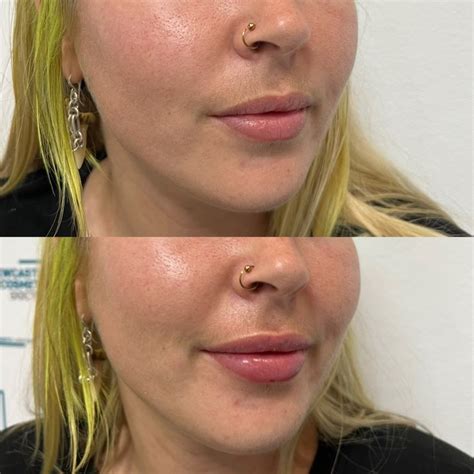 Pin By Newcastle Cosmetic Doctor On Lip Filler Lip Fillers Nostril