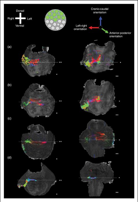 Figure 1 From Mapping The Trigeminal Root Entry Zone And Its Pontine