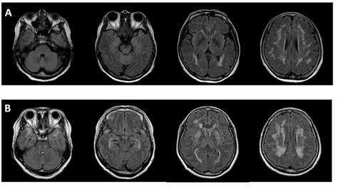Anterior Temporal Pole Involvement According To Cysteine Sparing Or Download Scientific Diagram