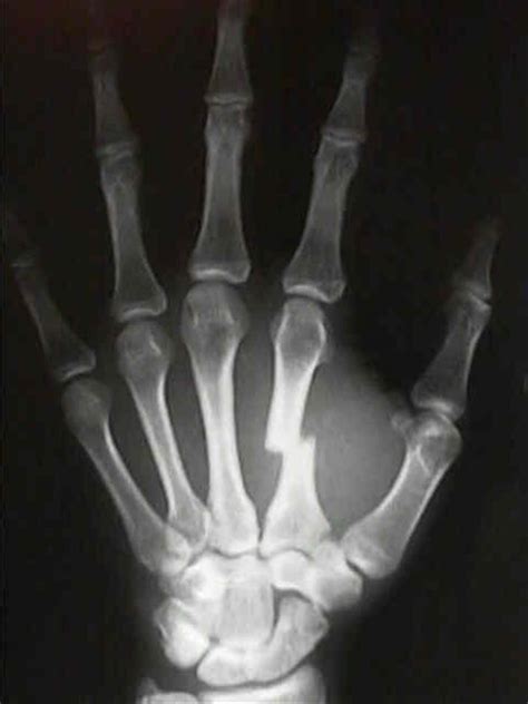 Broken Metacarpal X Ray