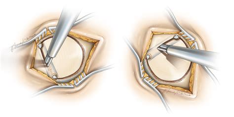 Occipital Craniotomy The Neurosurgical Atlas By Aaron Cohen Gadol M D