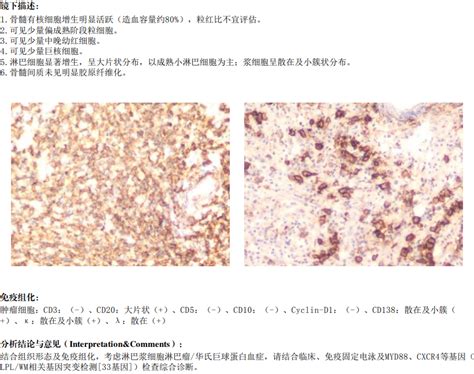 两个病例认识淋巴浆细胞淋巴瘤 华氏巨球蛋白血症（lpl Wm） 腾讯新闻