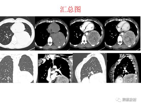胸膜孤立性纤维瘤影像表现 医学界 助力医生临床决策和职业成长