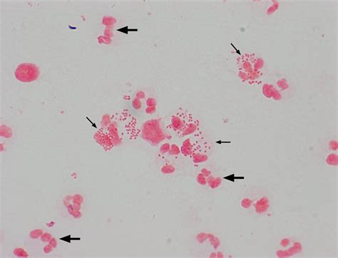 Neisseria Gonorrhoeae In Gram Stain Of Patient With Gonococcal Urethritis