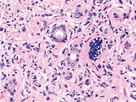 Neuroendocrine Tumors Of The Gastrointestinal And Pancreatobiliary