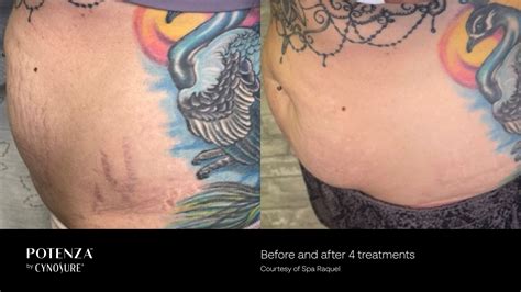 Stretch Marks Treatment Skinns Cosmetics