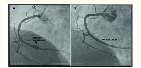 A Angiogram With The Pseudoaneurysm Before Treatment B Angiogram Download Scientific