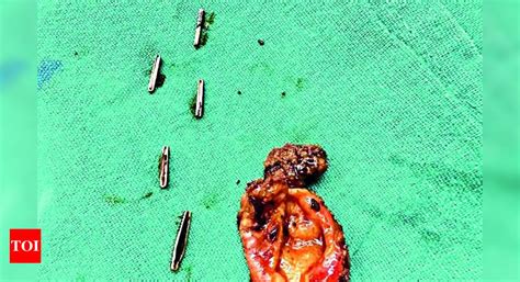 Surgery Docs Left 5 Clips In Gallbladder 5 Yrs Ago Removed Jaipur News Times Of India