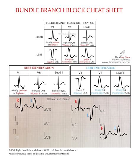 Bundle Branch Block