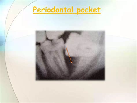 Impaction In Oral Surgery Pptx