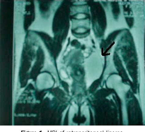 Figure 1 From Management Of Large Retroperitoneal Lipoma In A 12 Year