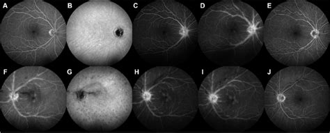 Angiographic Evolution Of Retinal Periphlebitis In Birdshot