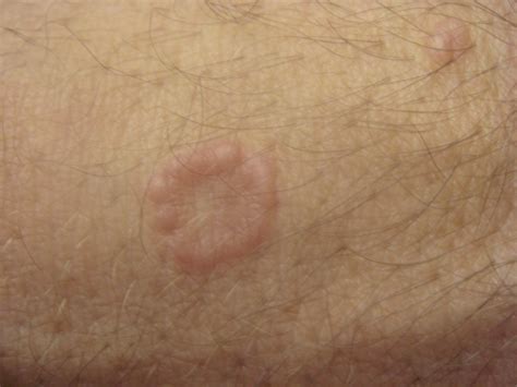 Granuloma Annulare Meddic