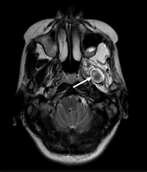 Axial T2 Weighted Mr Images Showing A Mass Of The Left Pterygoidien