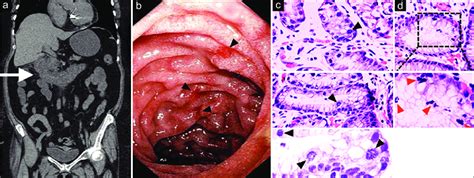 A Ct Scan Showing Duodenitis White Arrow B Egd Showing Diffuse Download Scientific