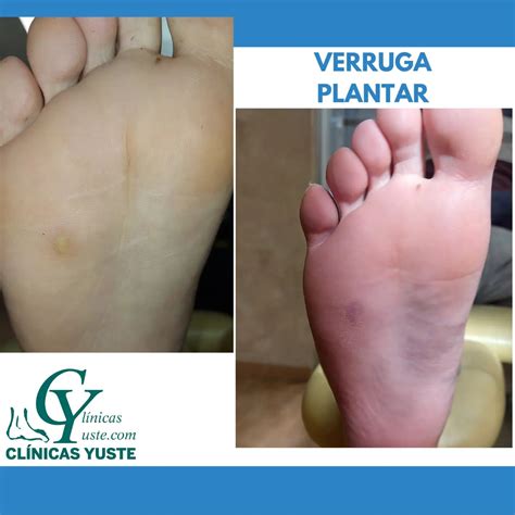 El Riesgo De Las Verrugas Plantares En El Vestuario Castellón Base