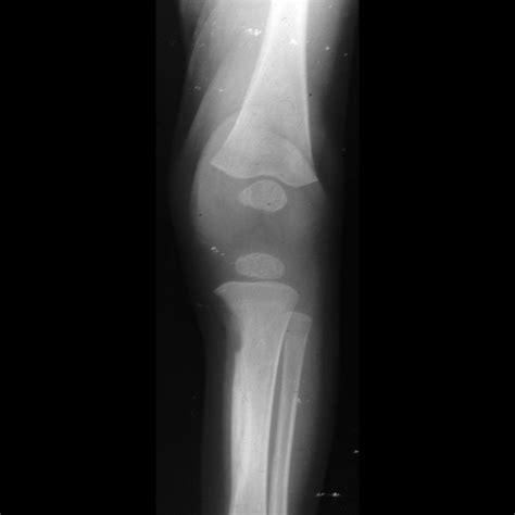Pediatric Syphilis Pediatric Radiology Reference Article Pediatric
