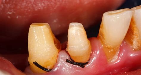 Teeth Shaving 6 Risks Why You Shouldnt Do It At Home