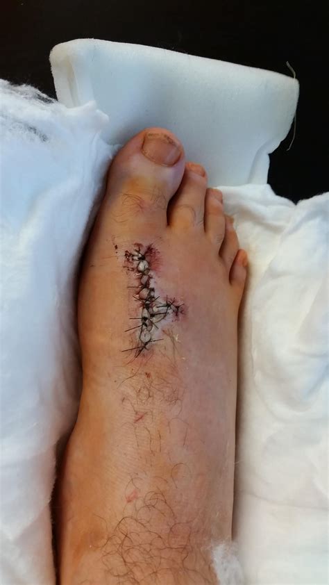 Has Anyone Here Ever Experienced A Severed Tendon Rrunning