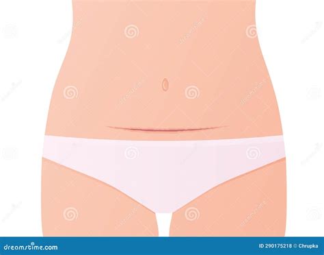 Woman Belly With A Scar From A Cesarean Section Stock Vector