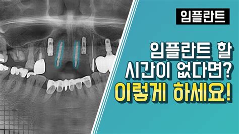 일반 임플란트를 할 시간이 안된다면 할 수 있는 방법 성남서울플러스치과 Youtube