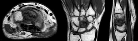 Resonancia Magnética De Mano Y Muñeca Resobert Medicina And Radiología