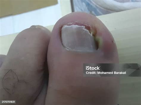 Ingrown Toenail With Abscess Left Male Toes Surgery Medical Condition