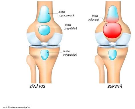 BURSITA CAUZE TIPURI SIMPTOME TRATAMENT WorkTape
