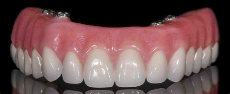 How To Clean Under Prettau Dental Implant Denture Dental News Network