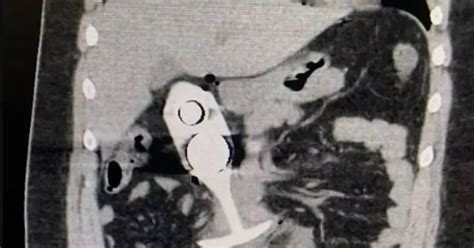 Woman Suffers Traumatic Injuries As Sex Toy Dragged Through Body In MRI Scan Daily Record