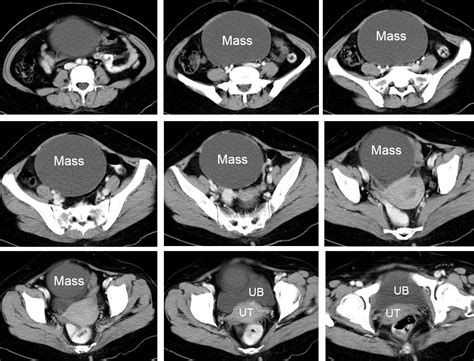 Ovarian Serous Cystadenoma Radiology Cases