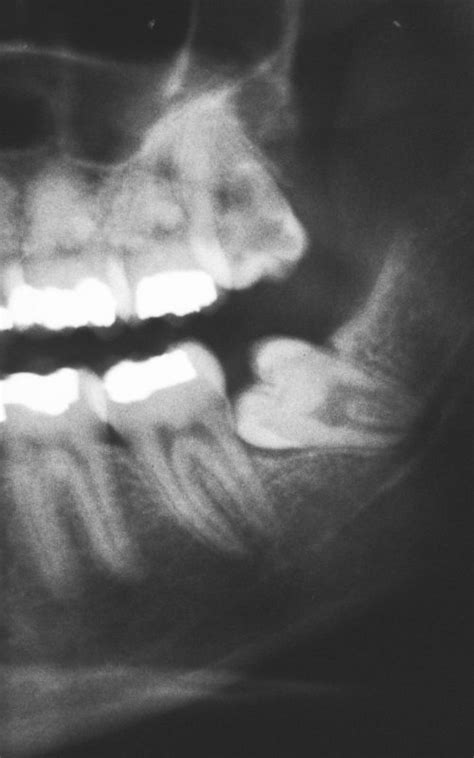 Affordable Wisdom Tooth Extraction In Quezon City