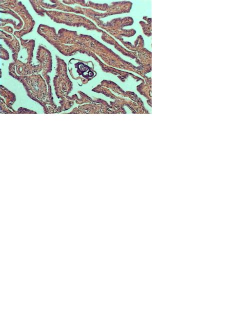 Robotic Hysterectomy With Bilateral Salpingo Oophorectomy What Is The
