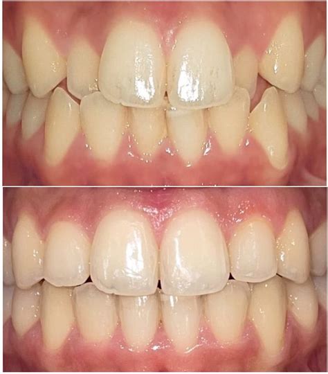 Teeth Correction Using Braces Before After Picture 1 Best Orthodontist And Dentist In Dubai Uae