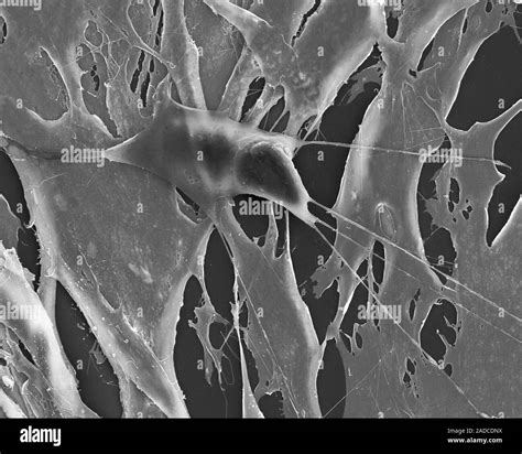 Human Lung Fibroblast Cancer Cell Among Healthy Fibroblasts Lung