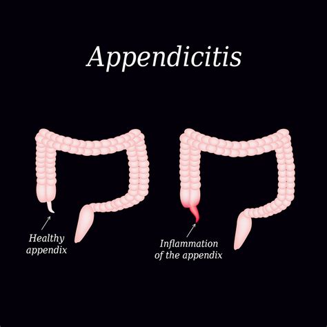 The Pancreas And New Info About The Appendix
