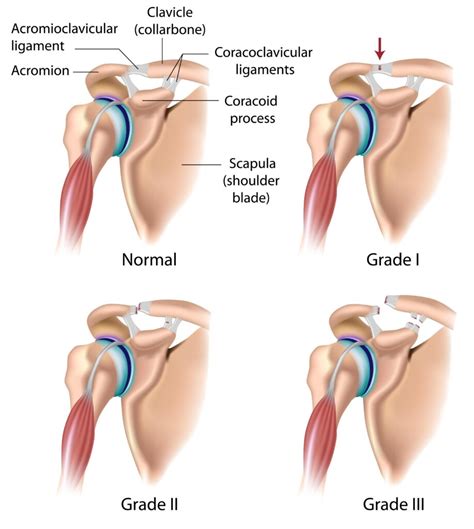 The Acromio Clavicular Ac Joint Common Conditions And Treatment